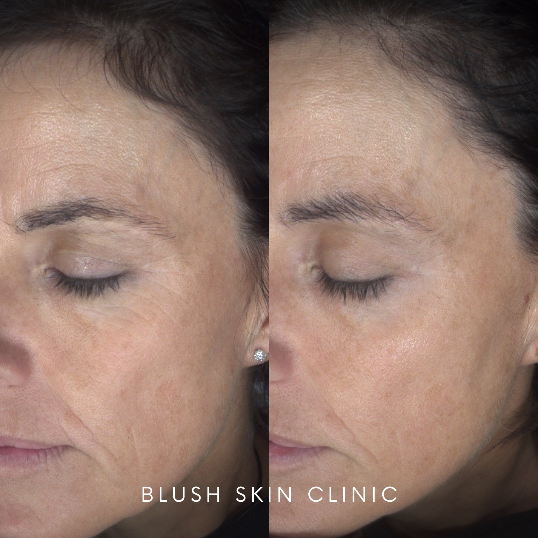 Laser – Blush Skin Clinic