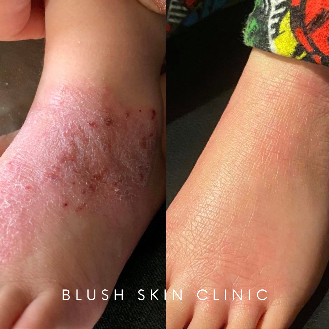 Before & After – Blush Skin Clinic