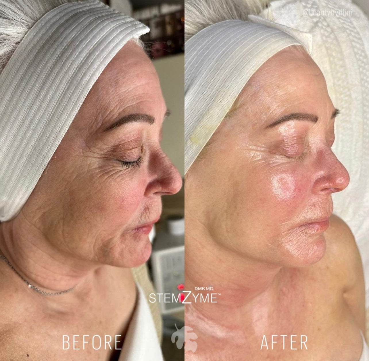 DMK STEMZYME – Blush Skin Clinic